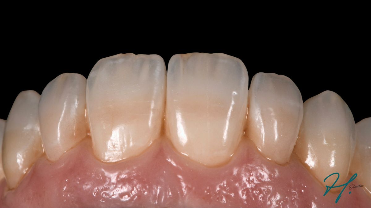 Micro Layering with Hugo Hebert and IPS e.max Ceram Art at Core Dental ...