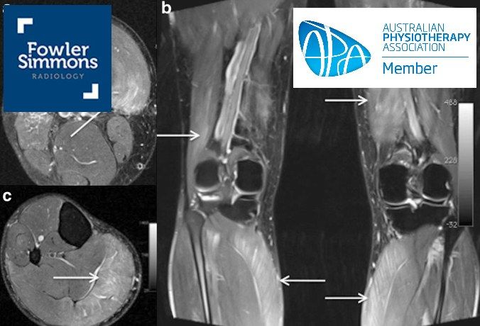 Fowler Simmons Radiology Lecture: "Lower limb muscle injuries, grading ...