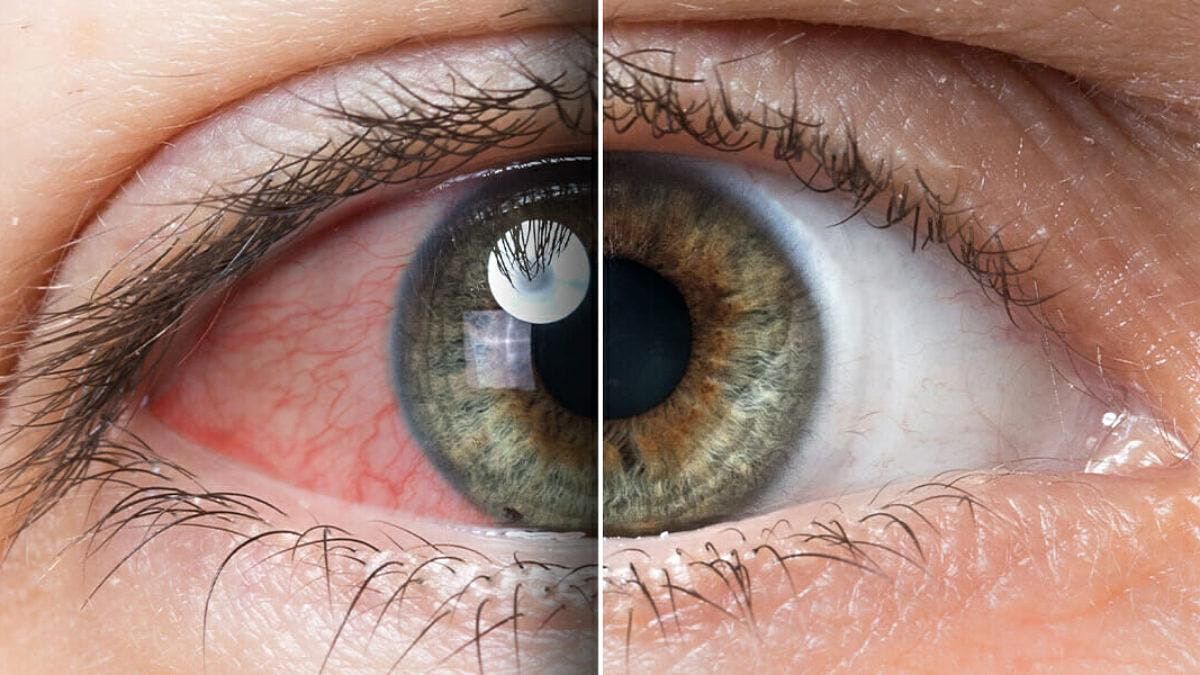 RCT: Comparison of dry eye (D.E.D) treatment between PRP vs serum eye ...