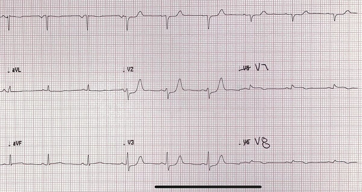 Cardiac Double Header: STEMIs and Tachys at Mountain Gateway Community ...